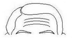 Types of Forehead Lines/Wrinkles, Vertical Frown Lines and Horizontal ...