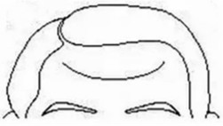 Types of Forehead Lines/Wrinkles, Vertical Frown Lines and Horizontal ...