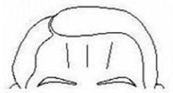 Types of Forehead Lines/Wrinkles, Vertical Frown Lines and Horizontal ...