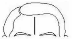 Types of Forehead Lines/Wrinkles, Vertical Frown Lines and Horizontal ...